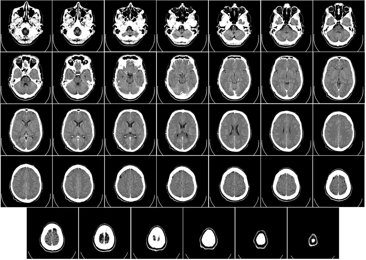 AI Model FastGlioma Revolutionizes Brain Tumor Detection During Surgery